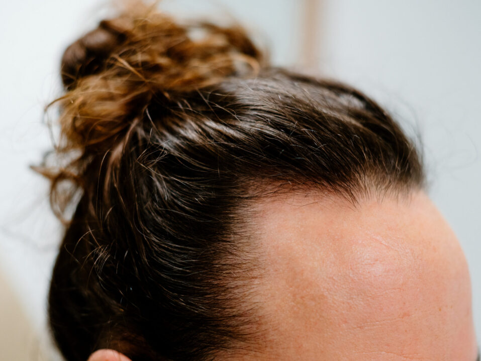 Mole Removal Columbus, Ohio | Donaldson Plastic Surgery